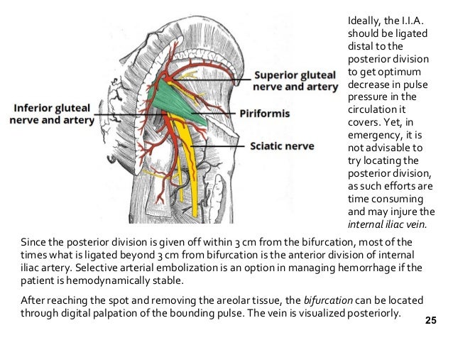 External Ligation of Internal Iliac Artery (E.L.I.I.A) - by Naira R.