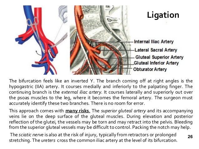 External Ligation of Internal Iliac Artery (E.L.I.I.A) - by Naira R.