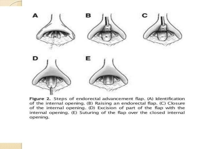 Ligation of Intersphincteric Fistulous Tract vs Endorectal Advancement.pptx