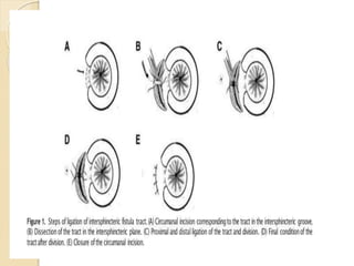Ligation of Intersphincteric Fistulous Tract vs Endorectal Advancement.pptx
