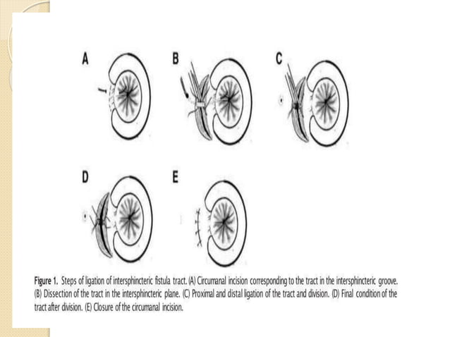 Ligation of Intersphincteric Fistulous Tract vs Endorectal Advancement.pptx