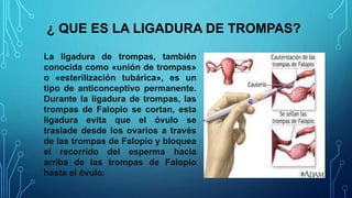 Ligadura De Trompas En España | Ligadura de trompas, qué es, cuándo y ...