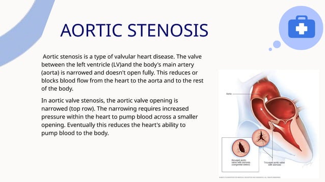 Sever Aortic stenosis, post tavi case study Medical | PPT
