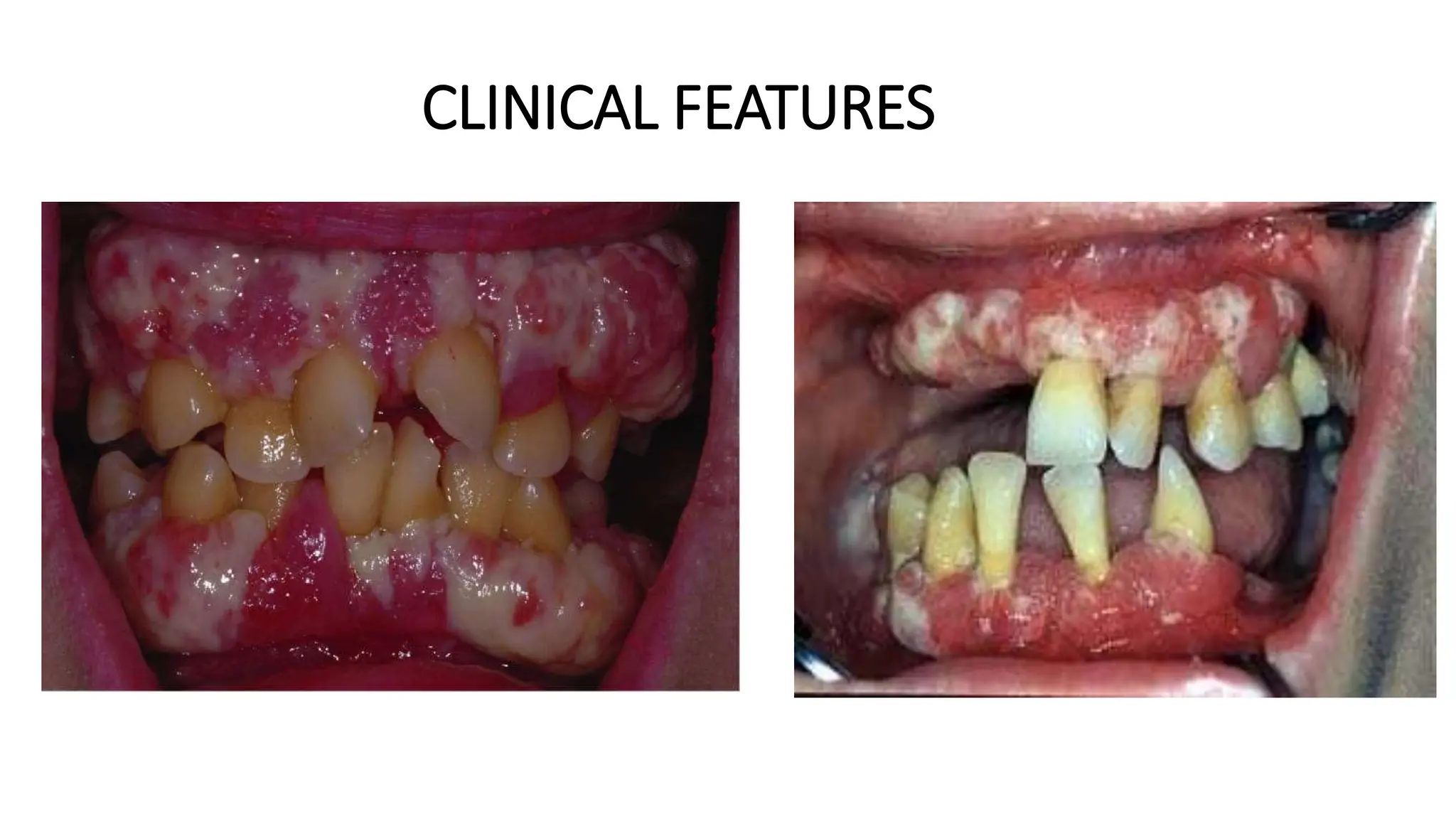 Ligneous periodontitis.pptx PERIODONTICS | PPTX