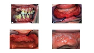 Ligneous periodontitis.pptx PERIODONTICS | PPT