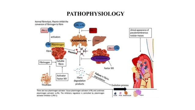 Ligneous periodontitis.pptx PERIODONTICS | PPT