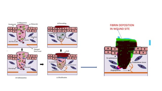 Ligneous periodontitis.pptx PERIODONTICS | PPT