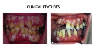 Ligneous periodontitis.pptx PERIODONTICS | PPTX
