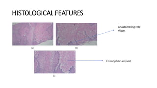 Ligneous periodontitis.pptx PERIODONTICS | PPT