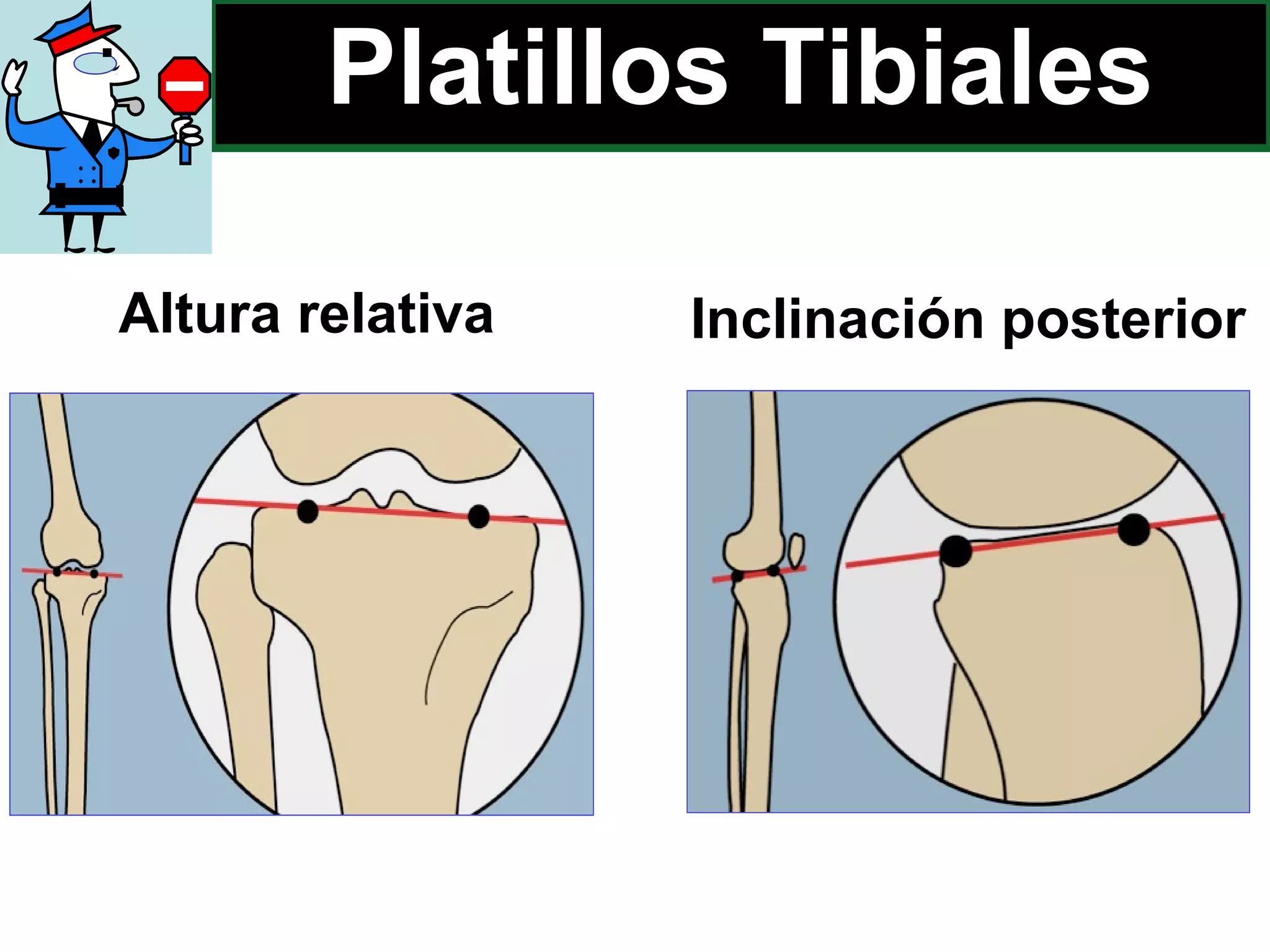 Lima 08 platillos tibiales 2 de mayo | PPT