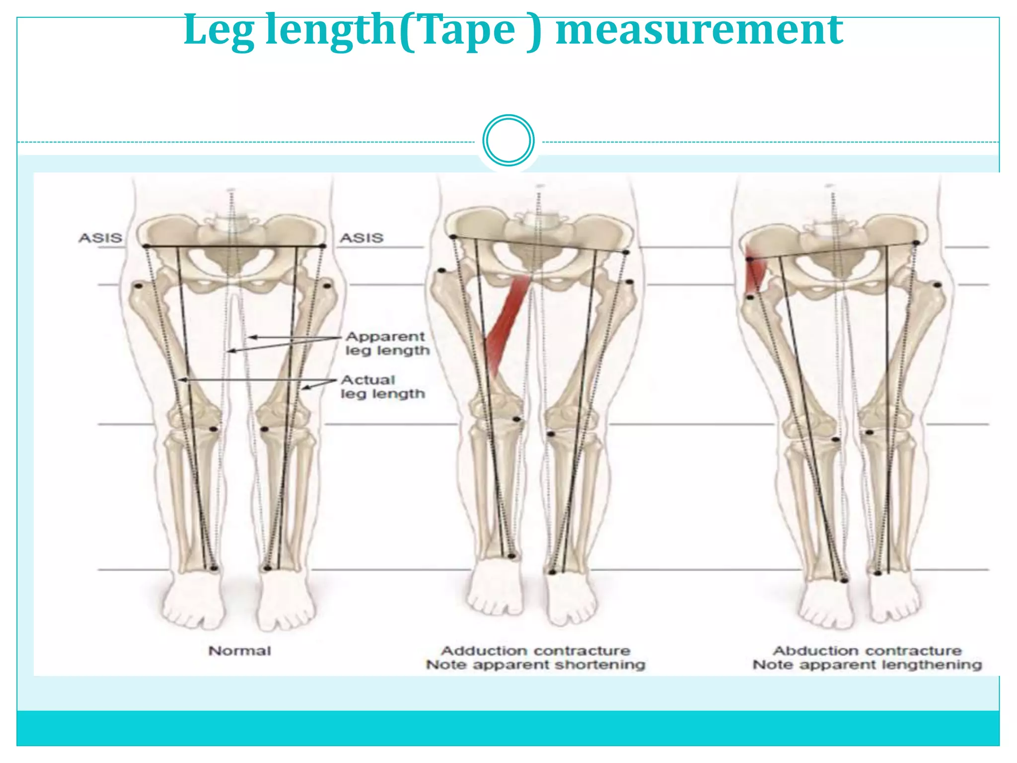 LIMB-LENGTH DISCREPANCY.pptx
