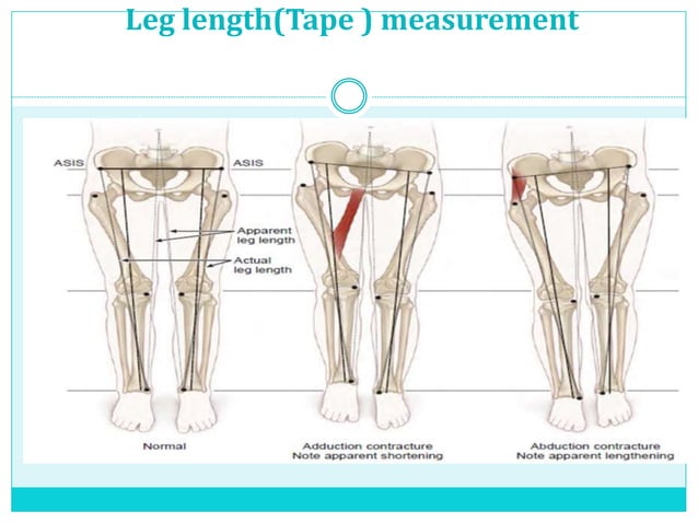 LIMB-LENGTH DISCREPANCY.pptx