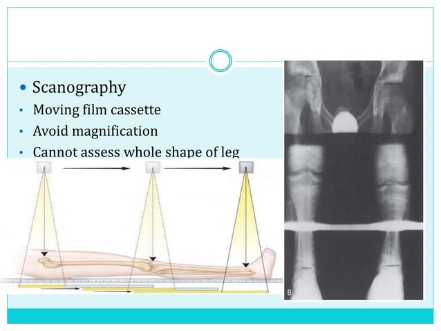 LIMB-LENGTH DISCREPANCY.pptx