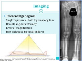 LIMB-LENGTH DISCREPANCY.pptx