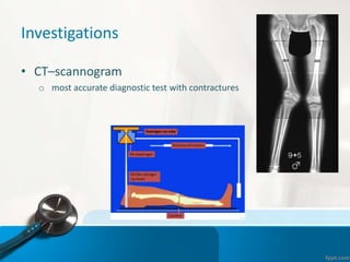 Limb length discrepancy evaluation | PPTX