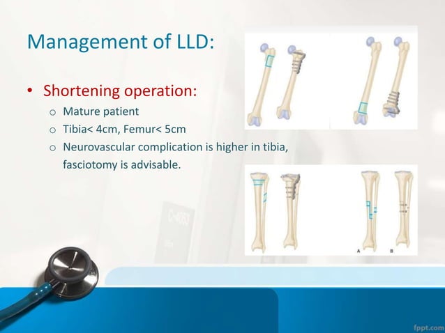 Limb length discrepancy evaluation | PPTX | Physical Therapy | Wellness