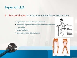 Limb length discrepancy evaluation | PPTX