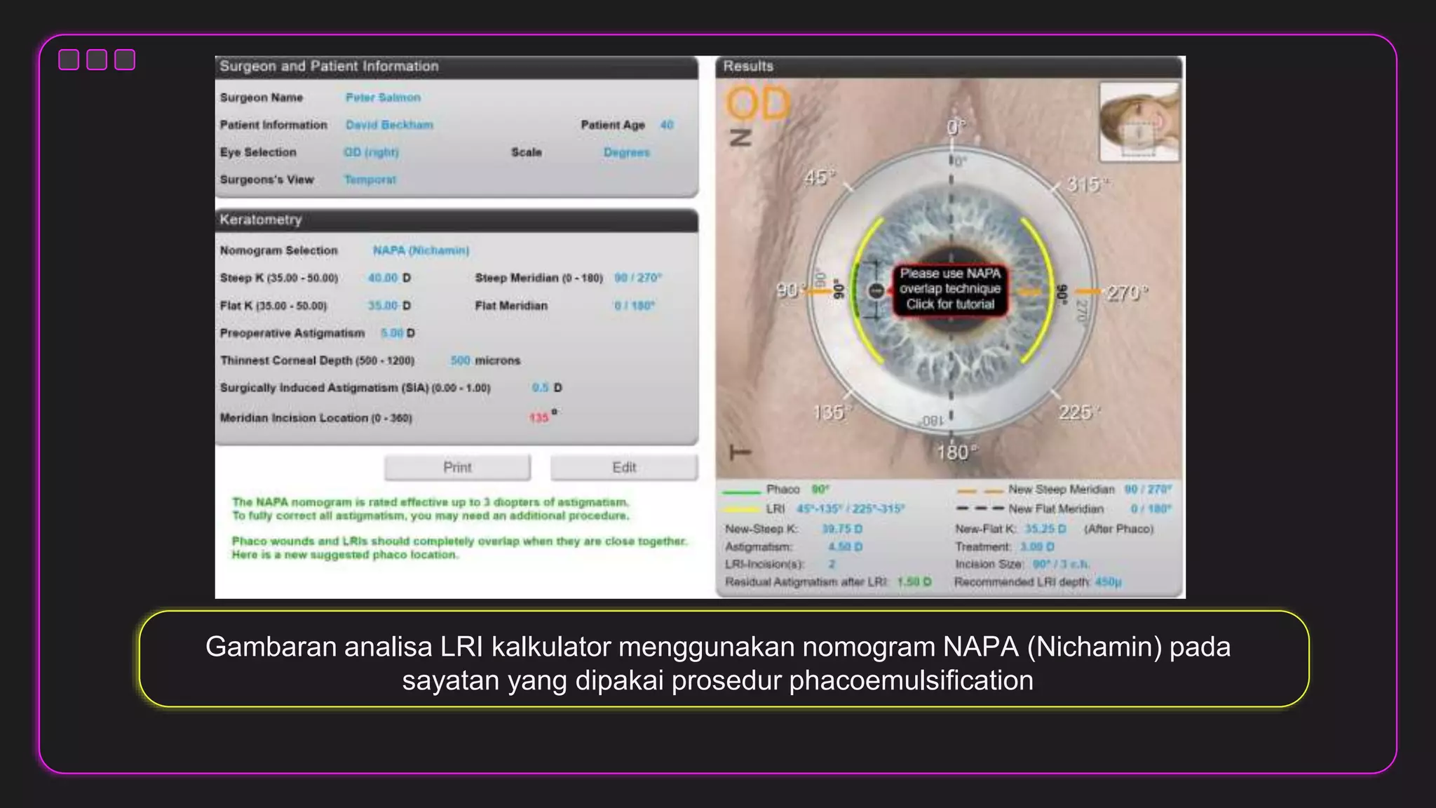 Limbal Relaxing Incisions fix2.pptx