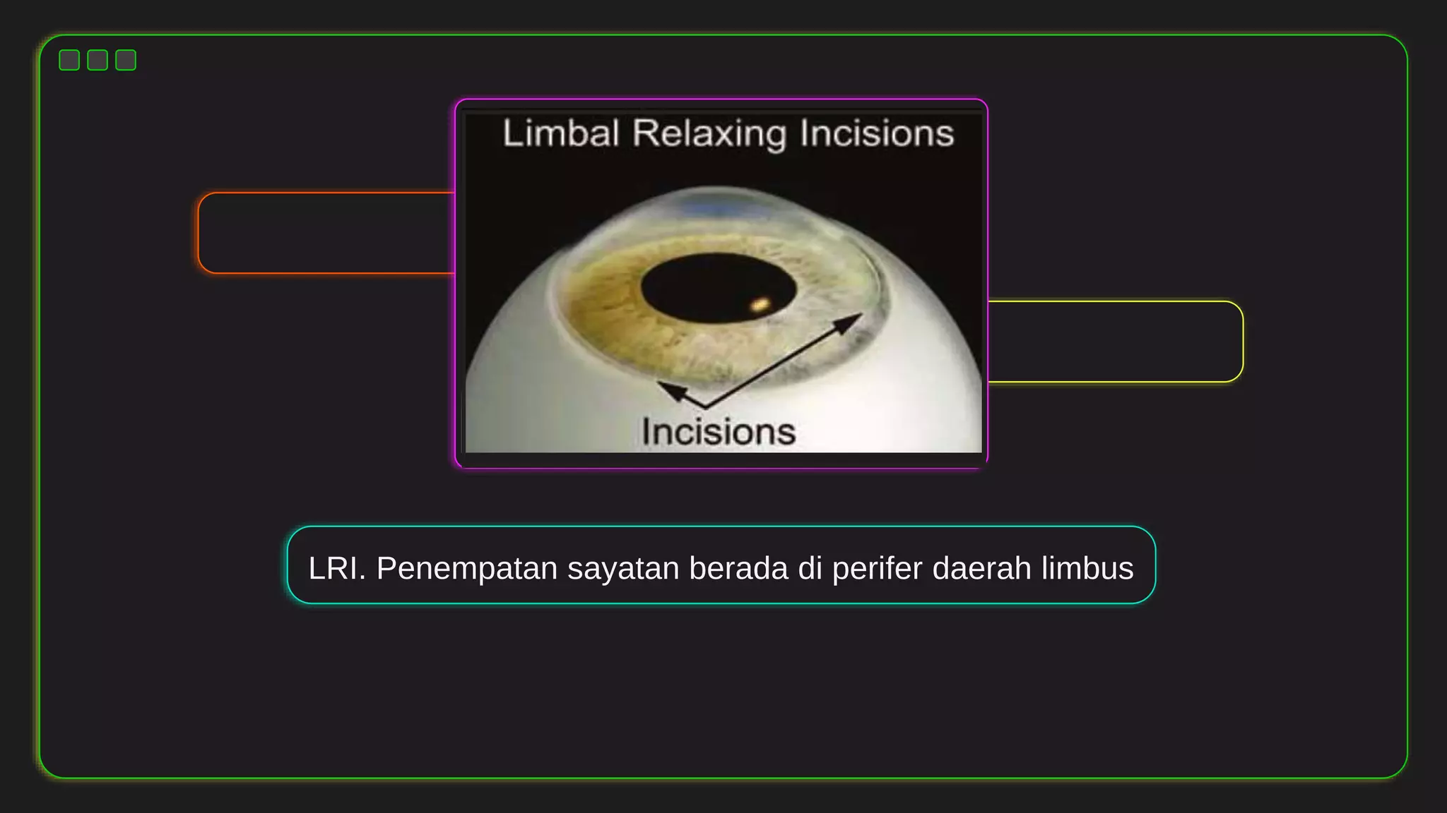 Limbal Relaxing Incisions fix2.pptx