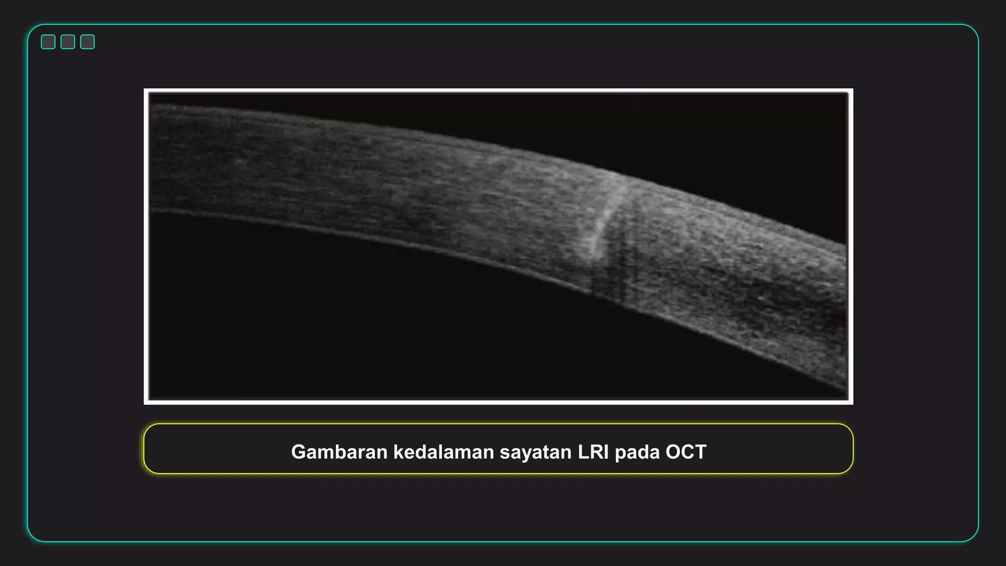 Limbal Relaxing Incisions fix2.pptx