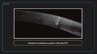 Limbal Relaxing Incisions fix2.pptx