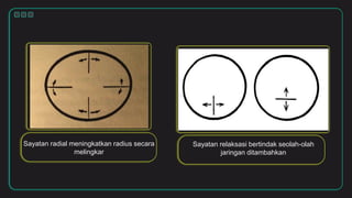 Limbal Relaxing Incisions fix2.pptx
