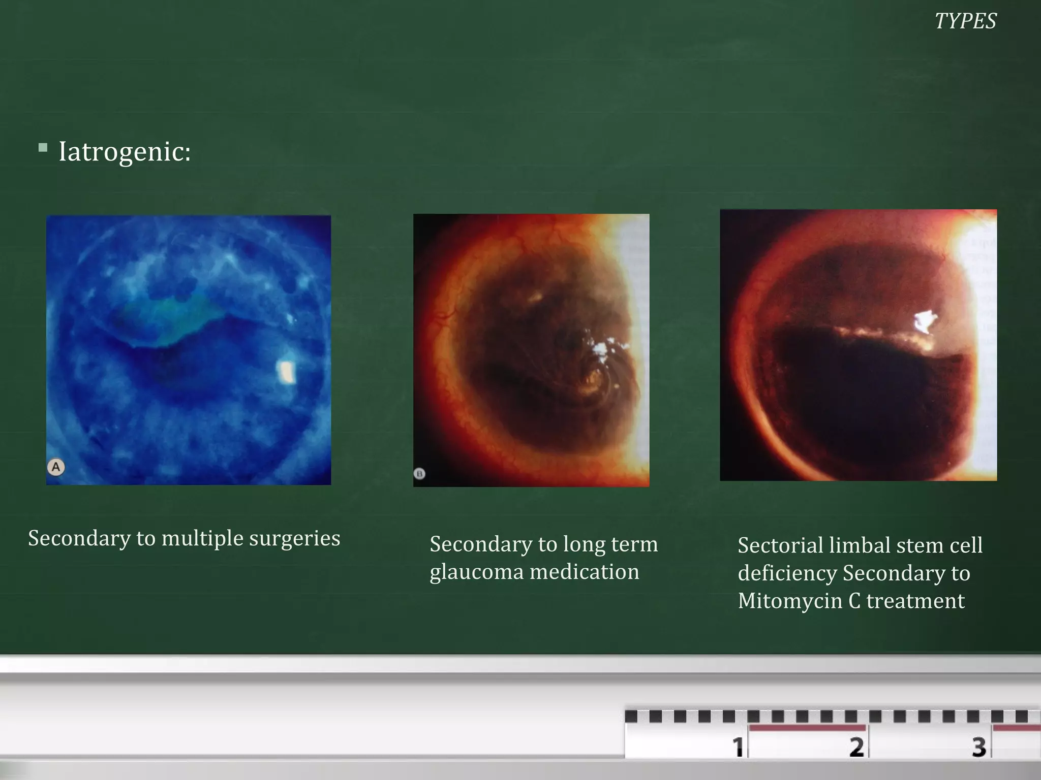 Limbal stem cell deficiency | PPT