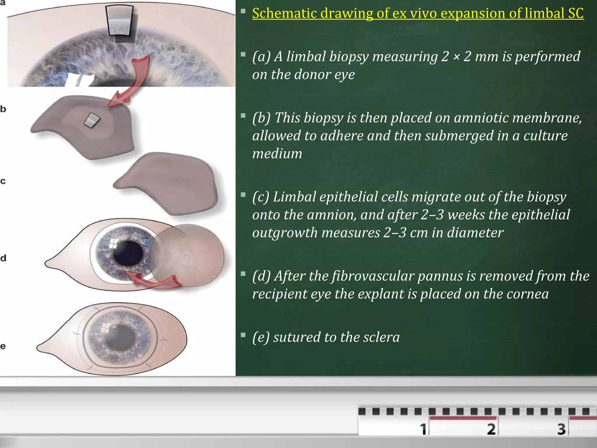 Limbal stem cell deficiency | PPT