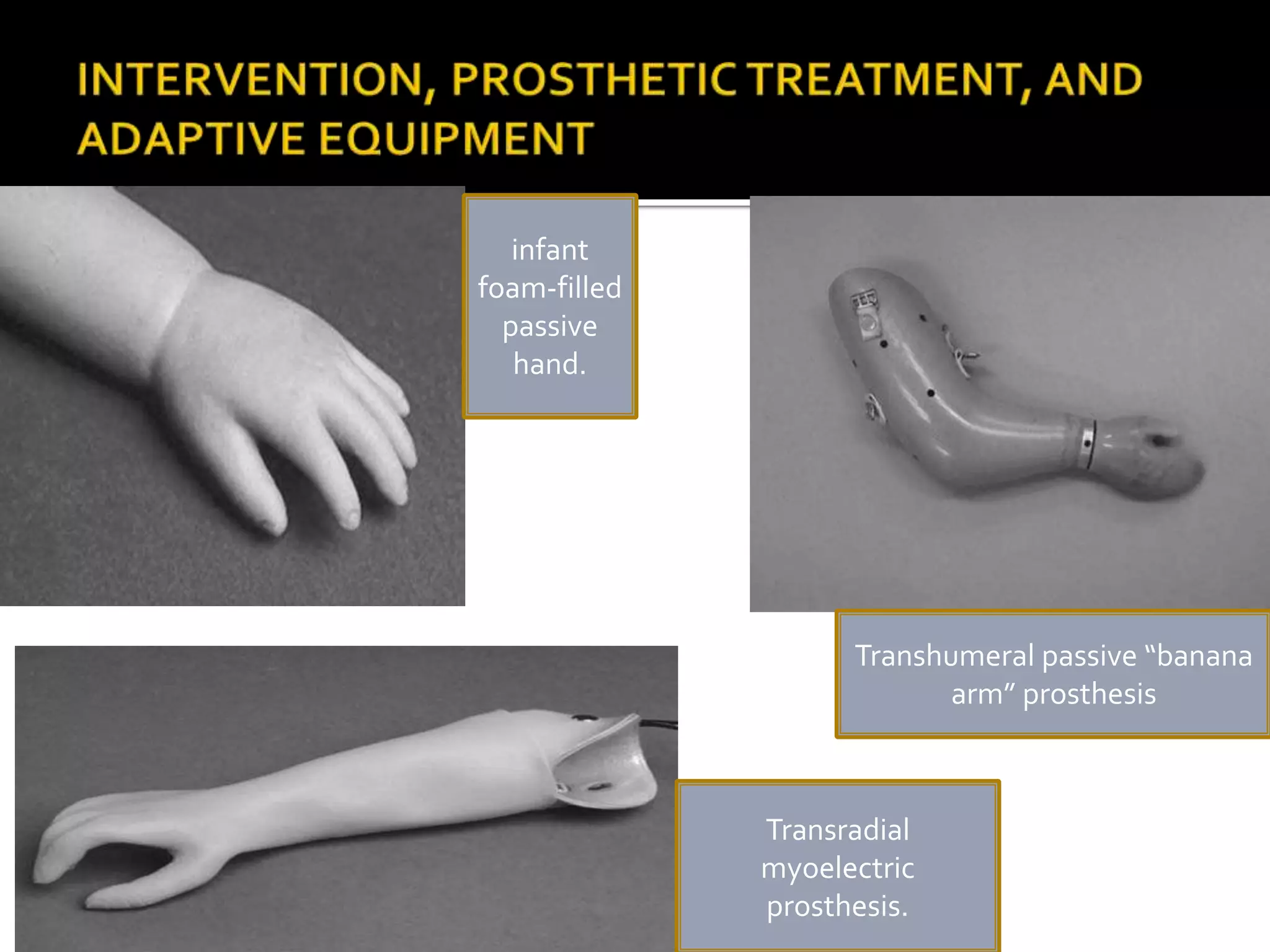 Limb deficiencies and amputations | PPTX