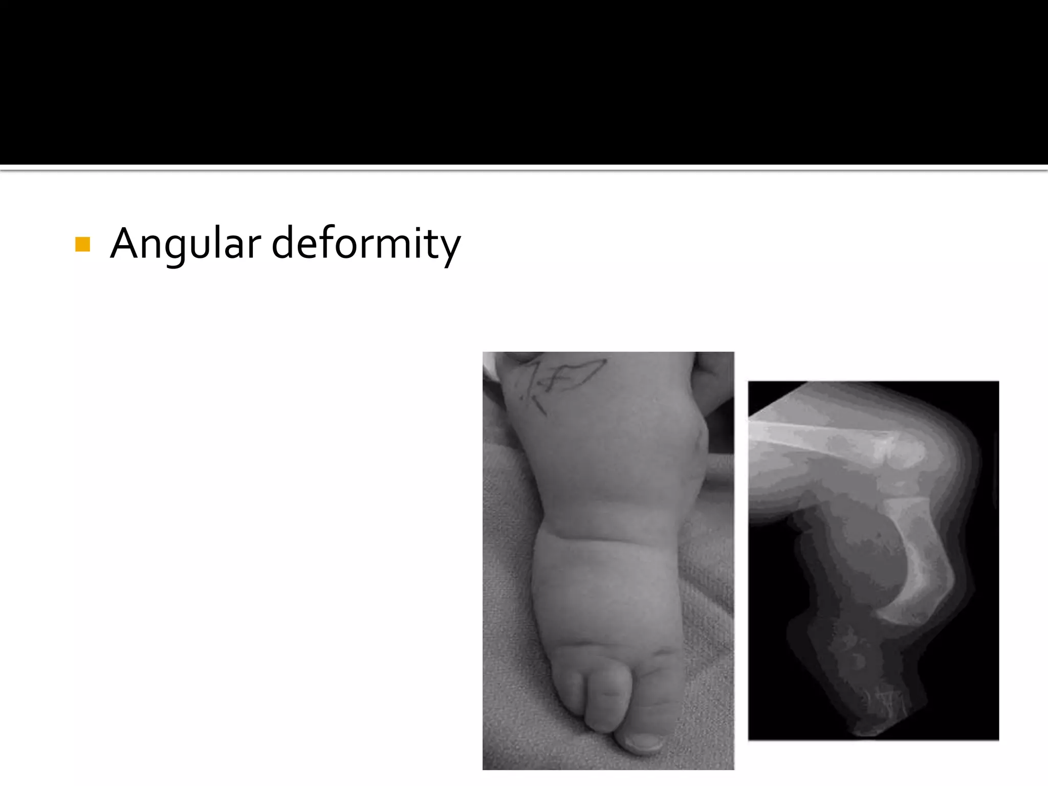 Limb deficiencies and amputations | PPTX