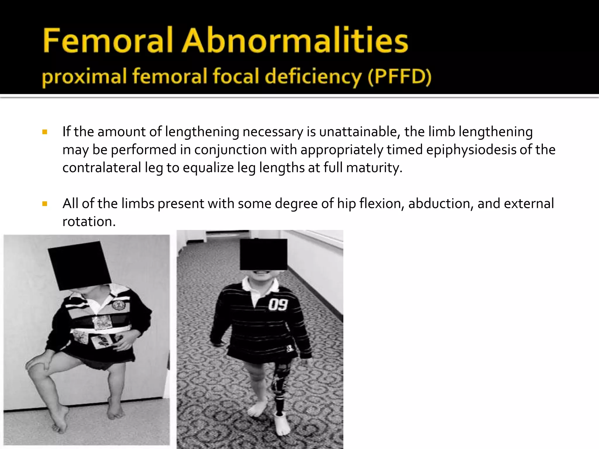 Limb deficiencies and amputations | PPTX