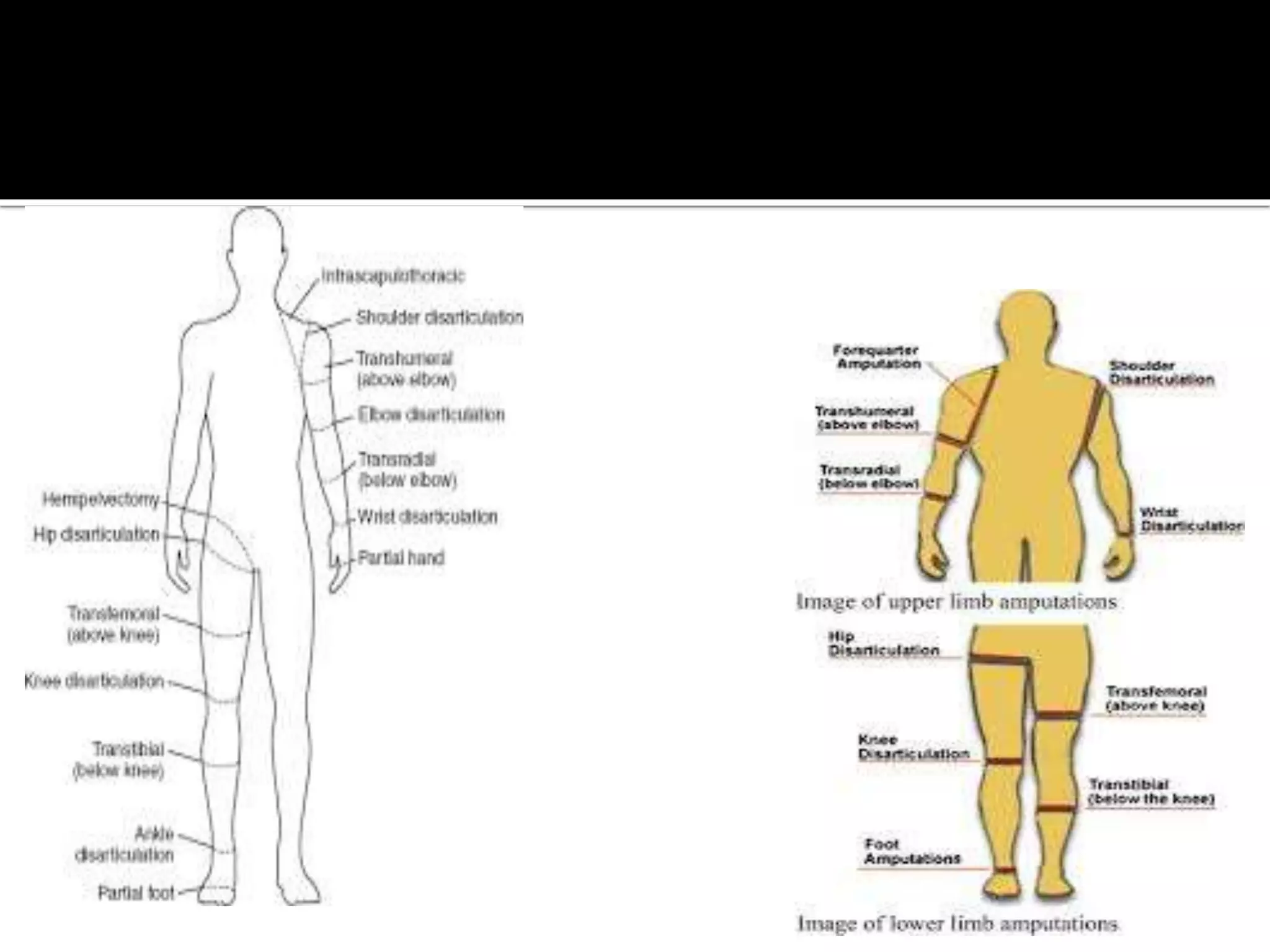 Limb deficiencies and amputations | PPTX
