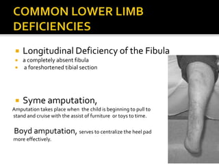 Limb deficiencies and amputations | PPTX