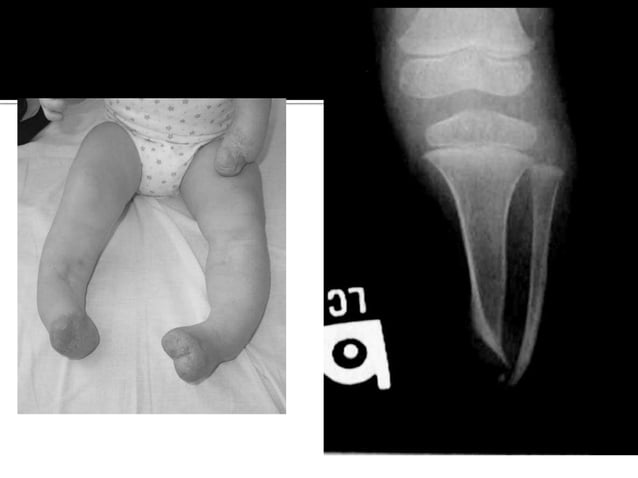 Limb deficiencies and amputations | PPTX
