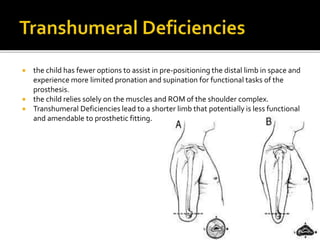 Limb deficiencies and amputations | PPTX