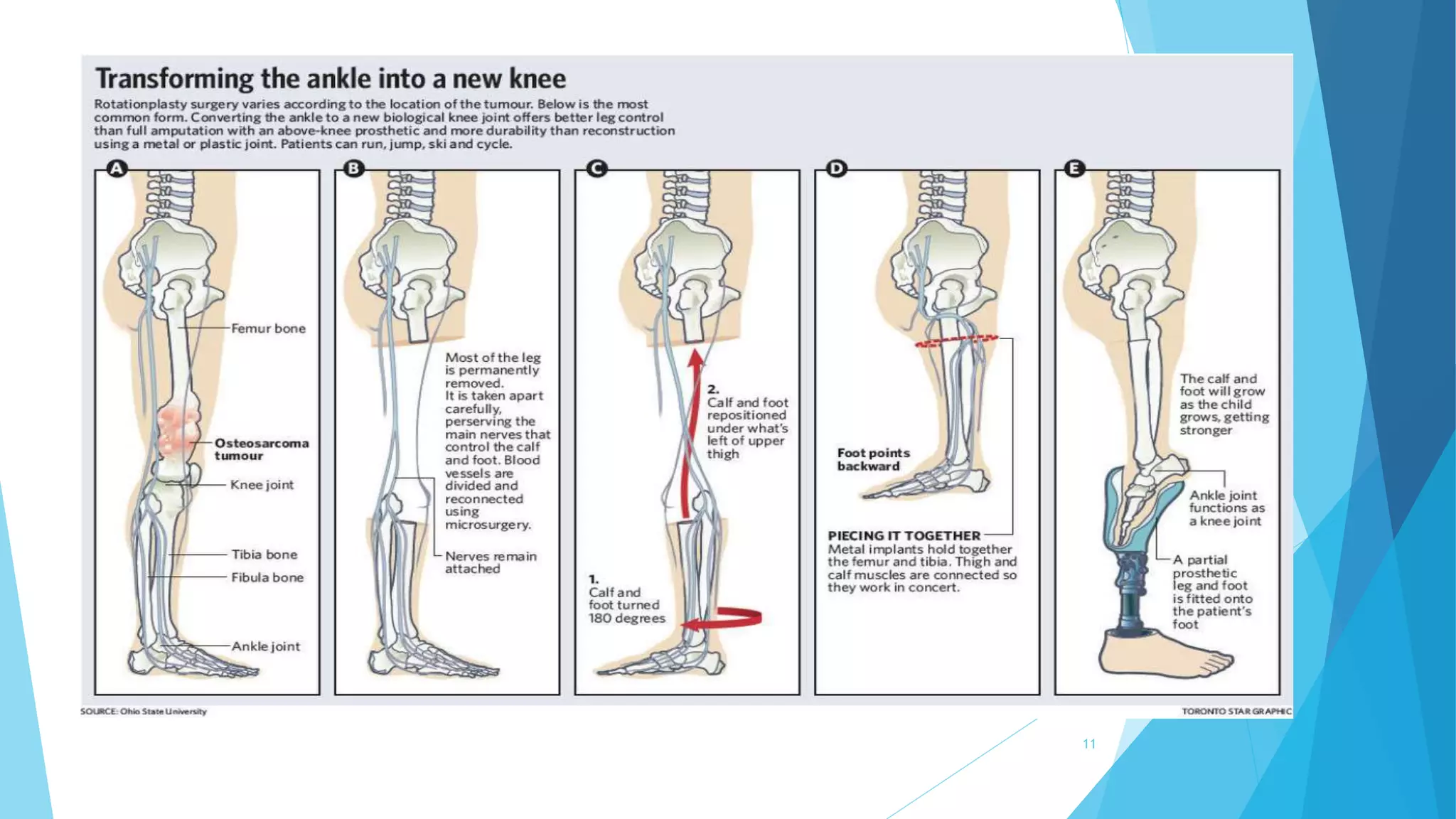Limb deficiencies and amputations | PPTX