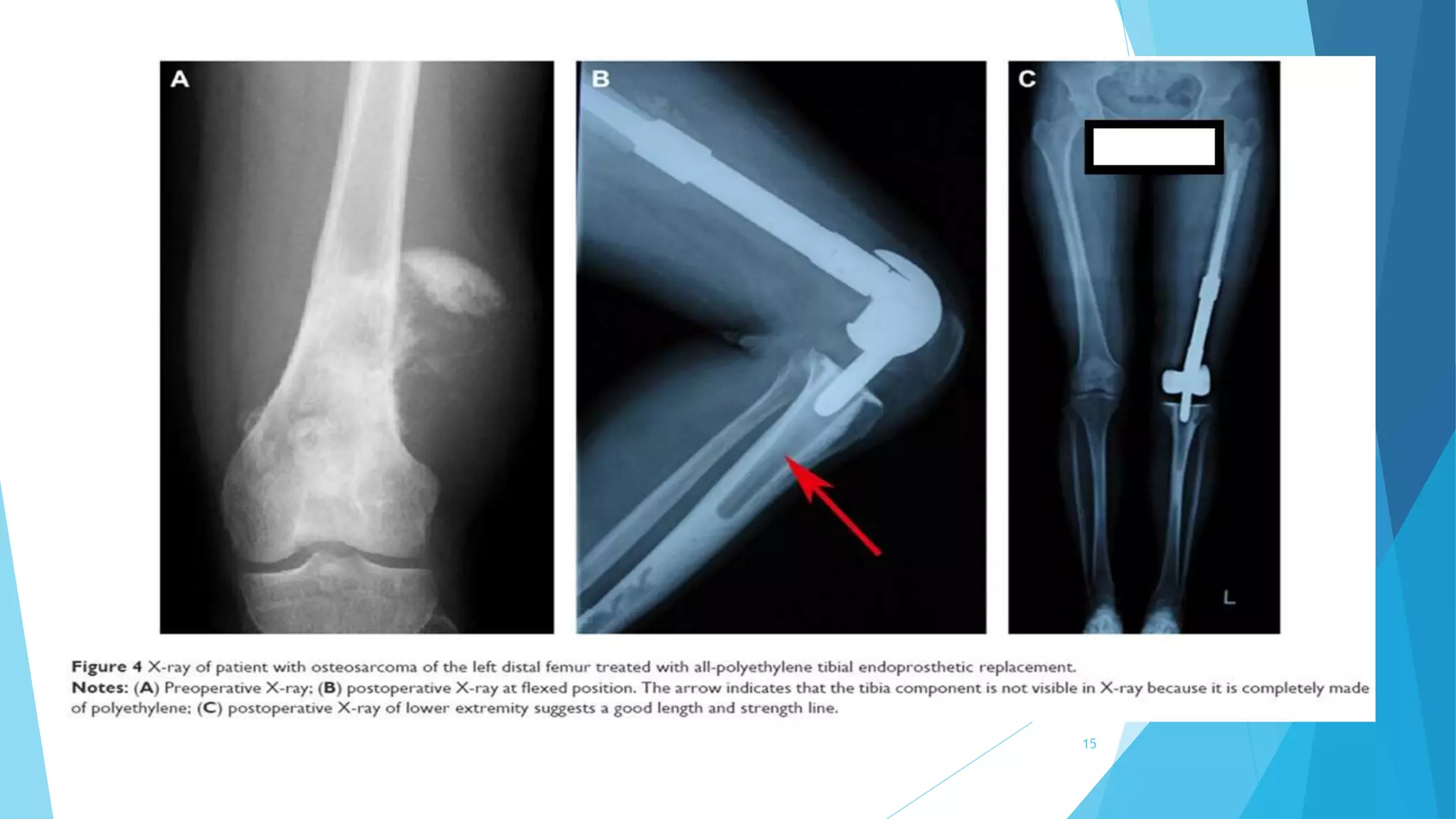 Limb deficiencies and amputations | PPTX