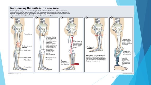 Limb deficiencies and amputations | PPTX | Foot Health | Diseases and ...