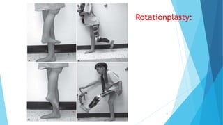 Limb deficiencies and amputations | PPTX