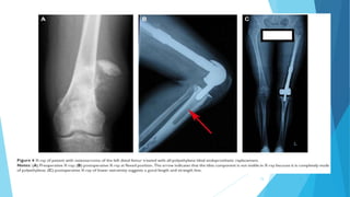Limb deficiencies and amputations | PPTX
