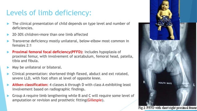 Limb deficiencies and amputations | PPTX | Foot Health | Diseases and ...