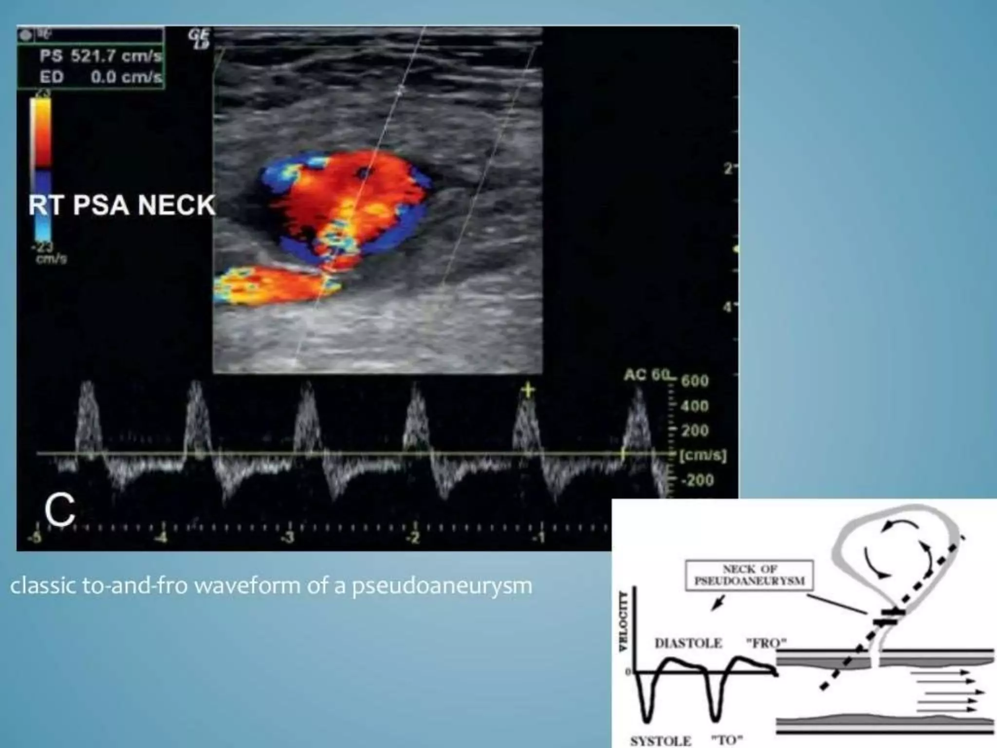 limb doppler ppt .ppt