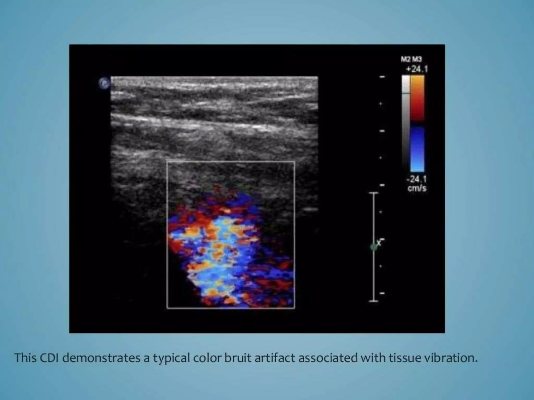 limb doppler ppt .ppt
