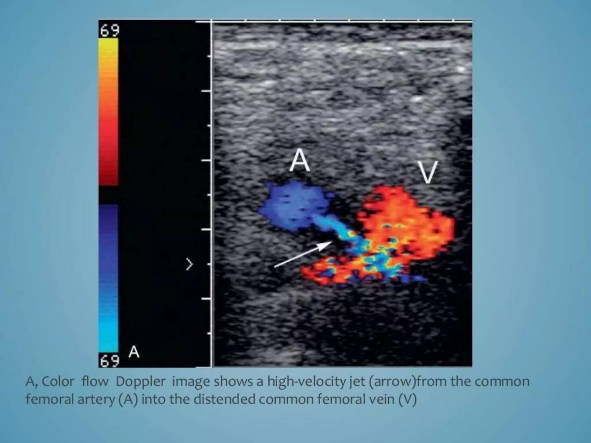 limb doppler ppt .ppt