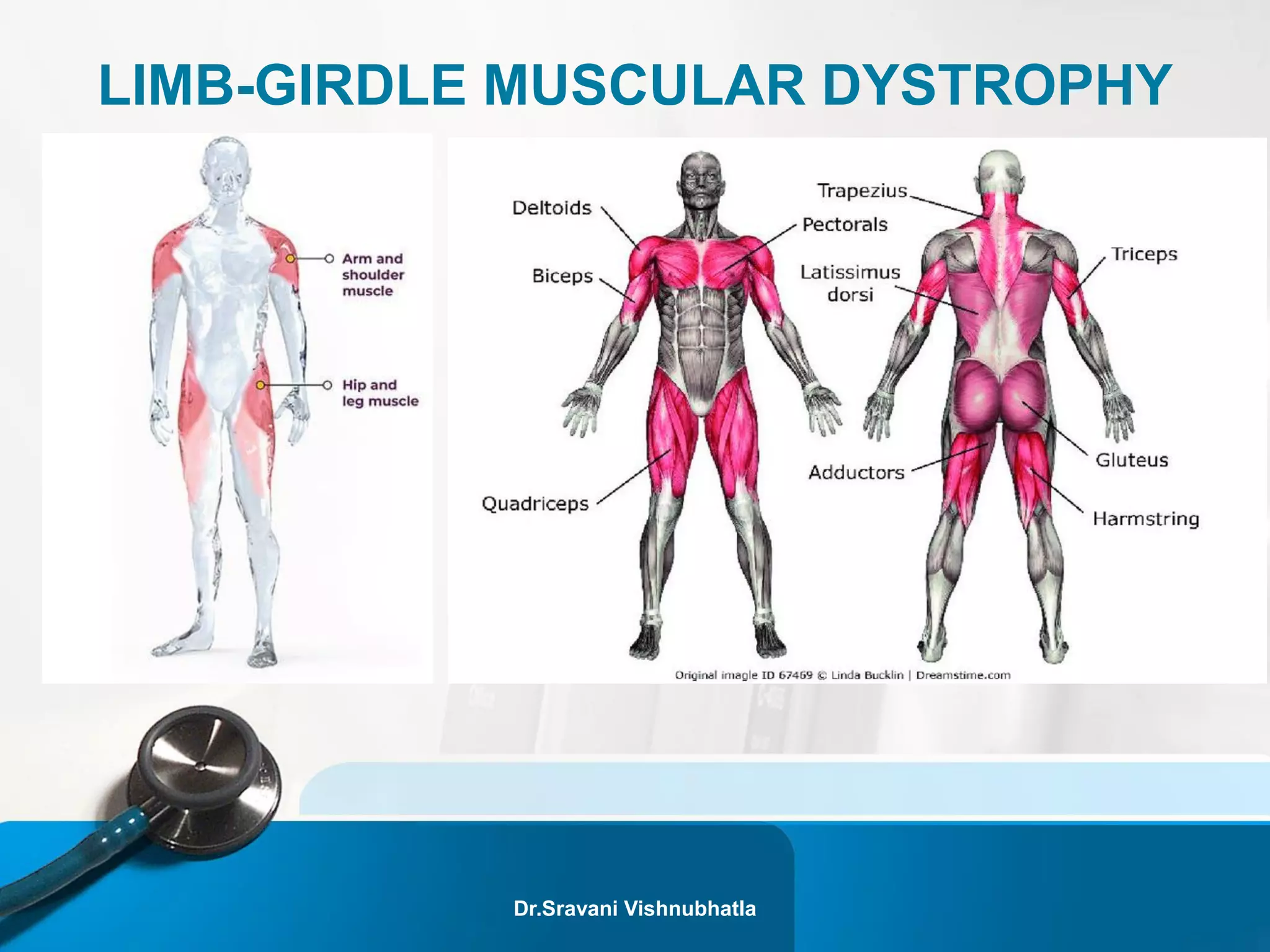 LIMB GIRDLE DYSTROPHY AND CAESARIAN SECTION by Dr.Sravani Vishnubhatla ...