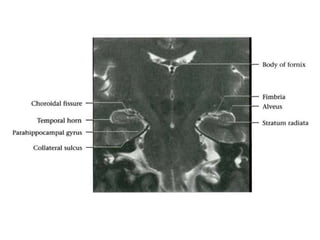 Limbic System Anatomy Mri