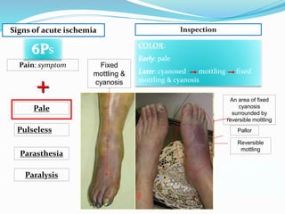 LIMB ISCHEMIA-ACUTE.pptx