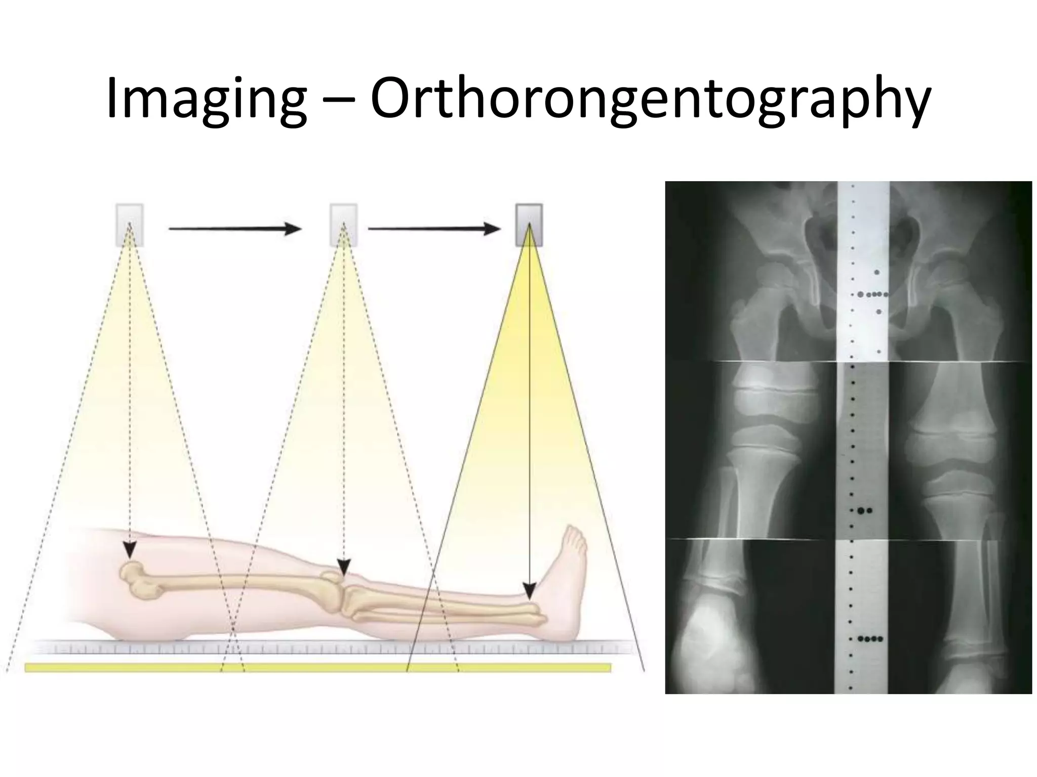 Limb length discrepancies | PPTX