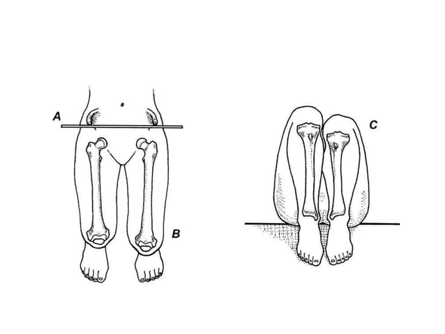 Limb length discrepancies | PPTX | Death, Injury, or Military Conflict ...