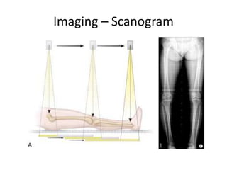Limb length discrepancies | PPTX | Death, Injury, or Military Conflict ...